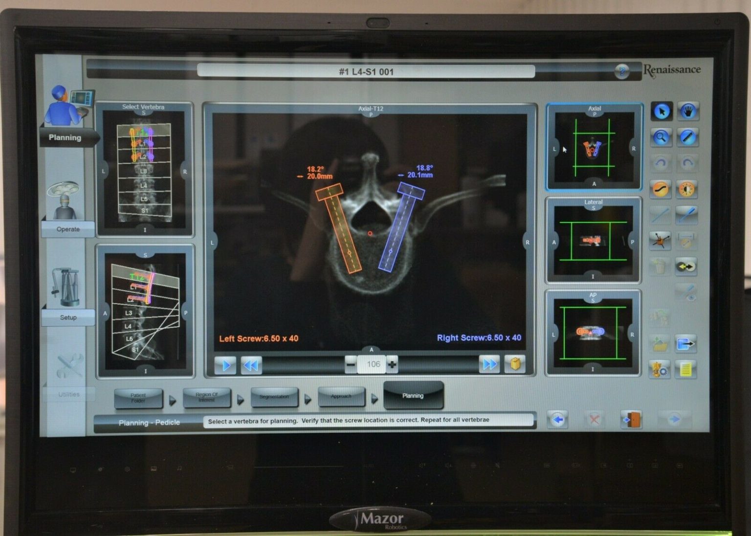 Mazor Robotics Renaissance Surgical Guidance System – Rhino Trade LLC