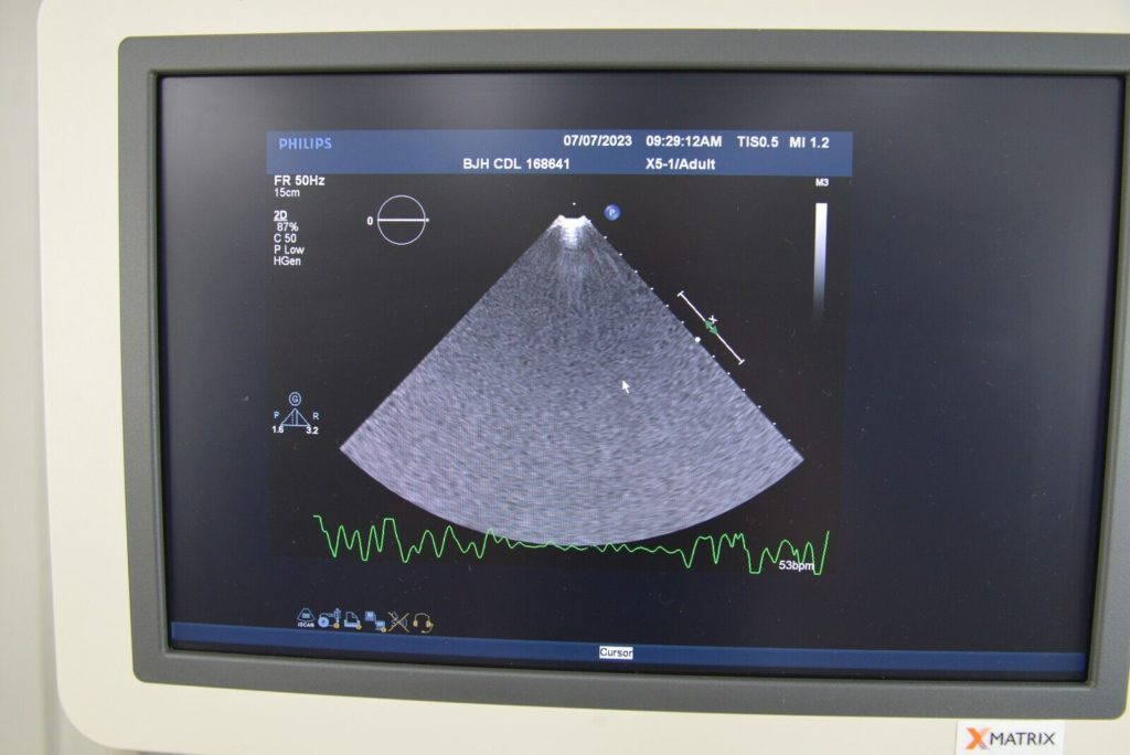 Philips IE33 Diagnostic Imaging System 8500-0082 W/ Philips X5-1 Matrix ...