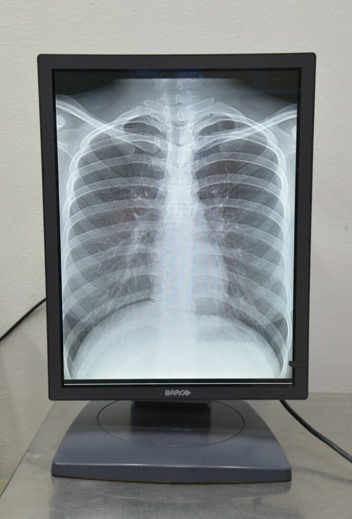 Lot of 2 Barco Coronis MDCG 2121 Diagnostic Grayscale Display System ...